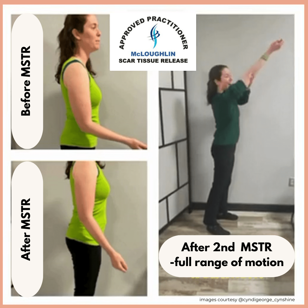 McLoughlin Scar Tissue Release | Mind Body Kinect